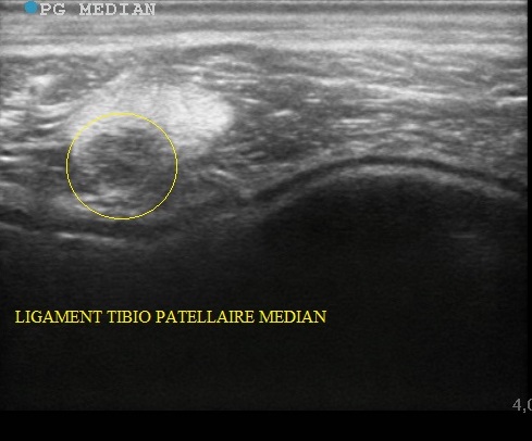 Echographie d’une lésion ligamentaire du grasset | Cheval Partenaire